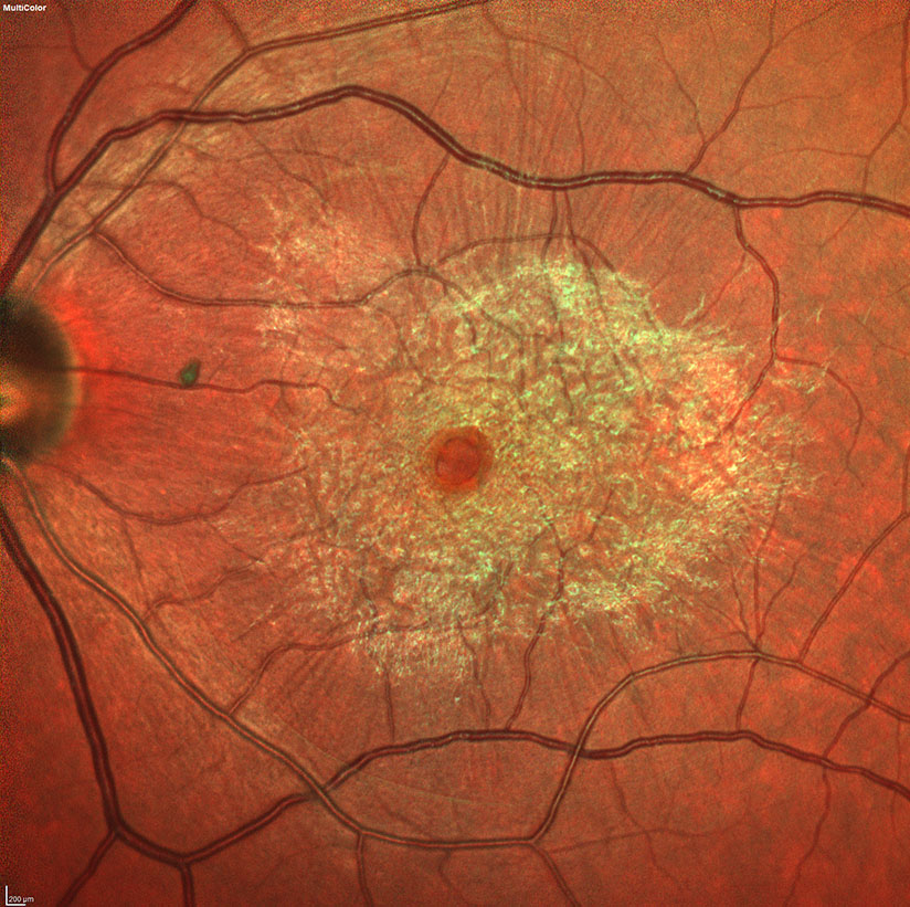 Retina And Uveitis Center